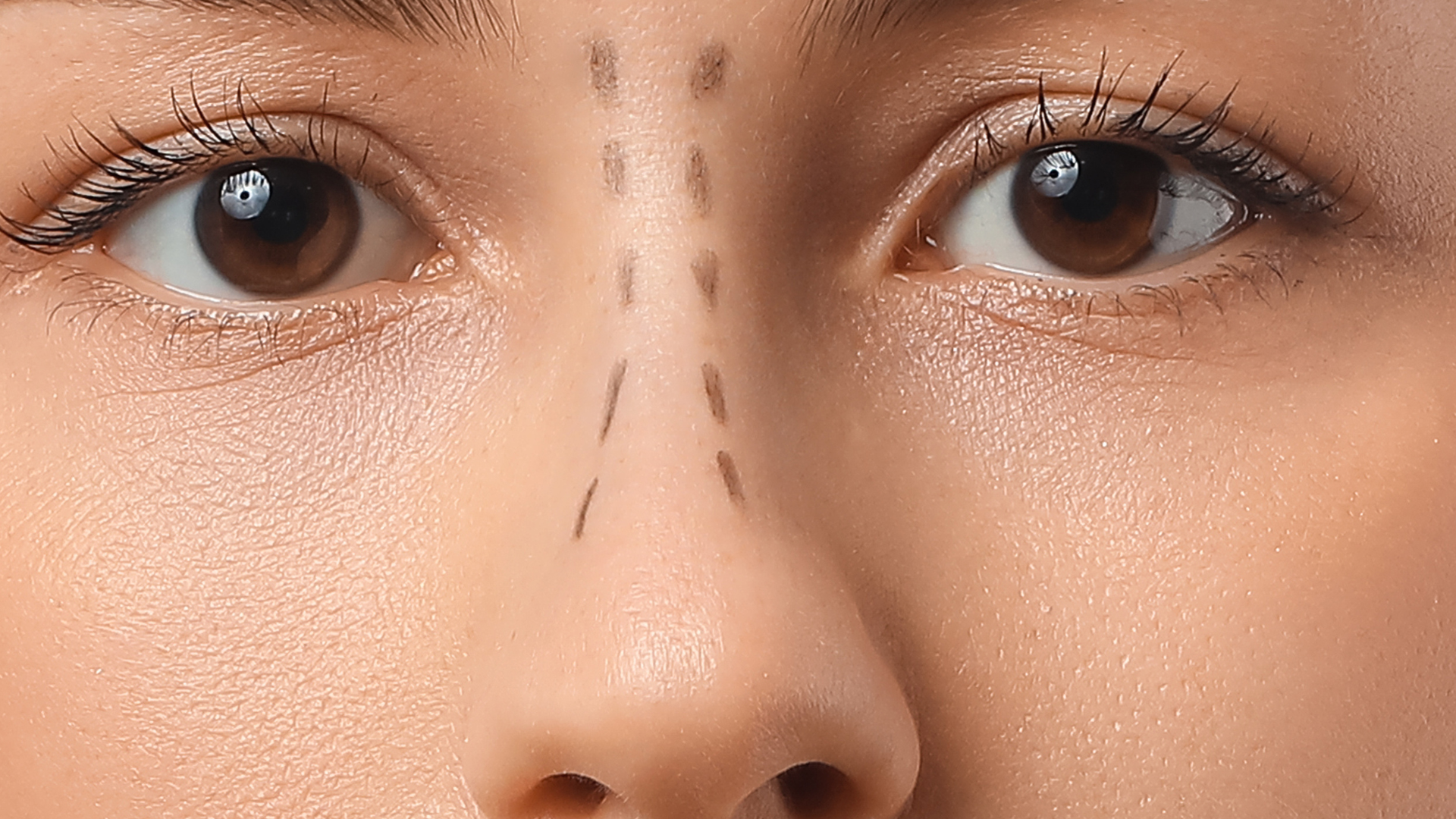 I want a higher nose bridge but don't want surgery. Is a nose thread ...