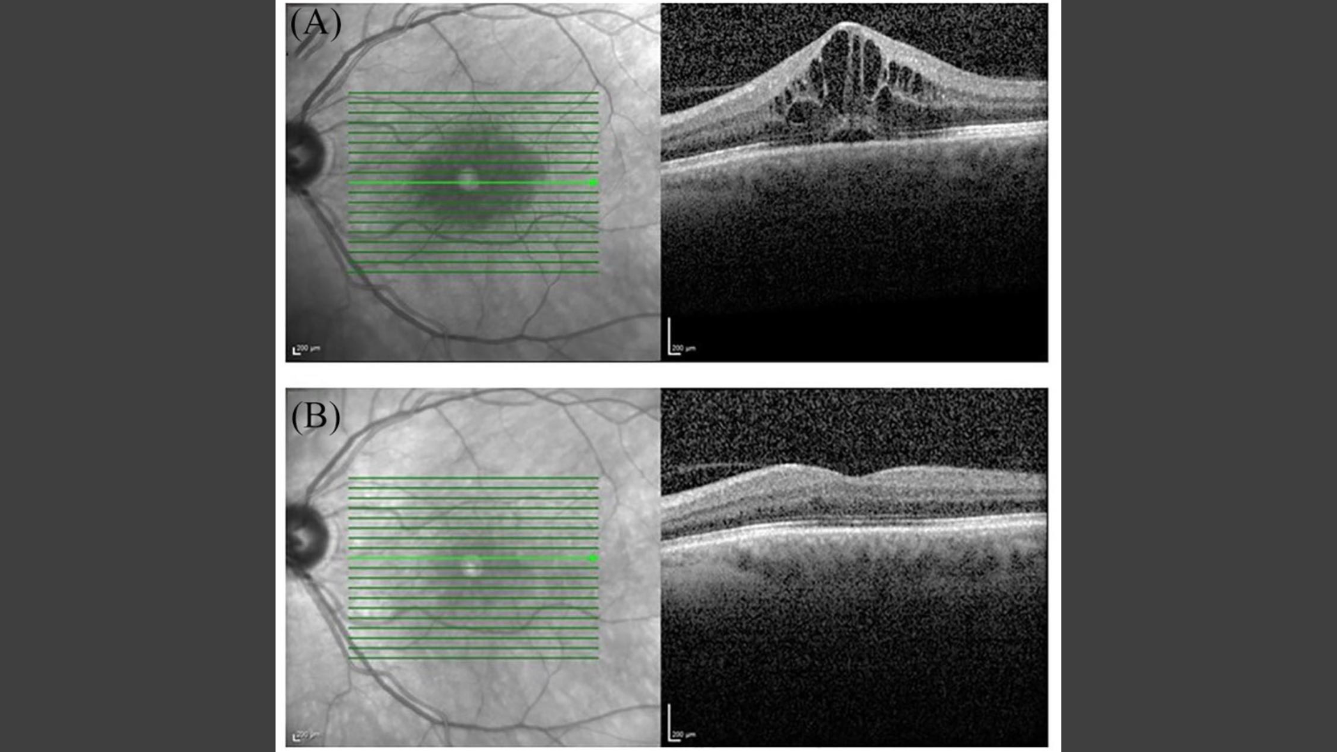 Blurred Vision After Cataract Surgery: Causes, Diagnosis, and ...